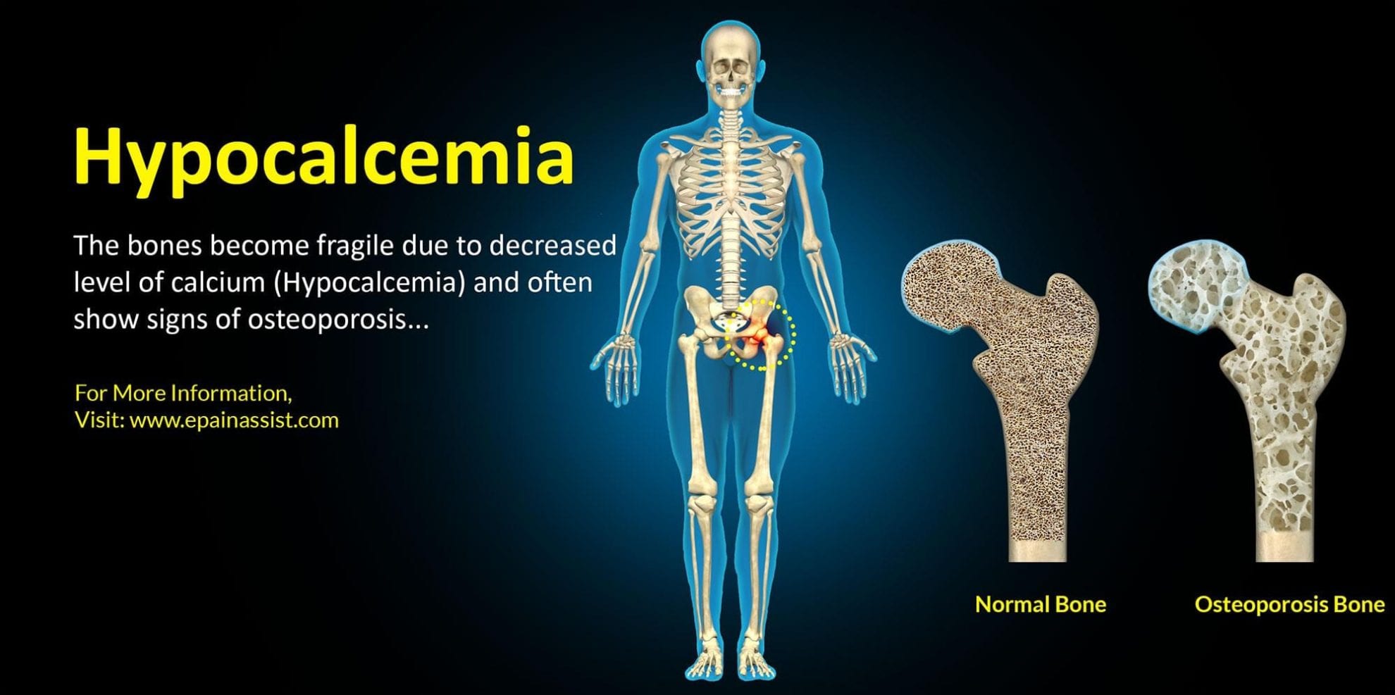 What is Hypocalcemia (Calcium Deficiency) and how to combat it ...
